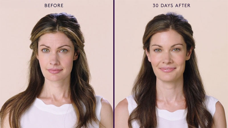 Botox® - Jackson Health & Wellness